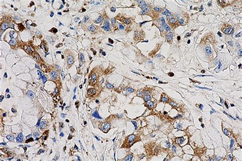 Activating An Estrogen Receptor Can Stop Pancreatic Cancer Cells From