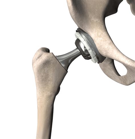 Materials Used In Hip Replacement Implant At Sarah Alanson Blog
