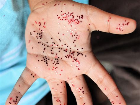 Holes In Skin On Hands
