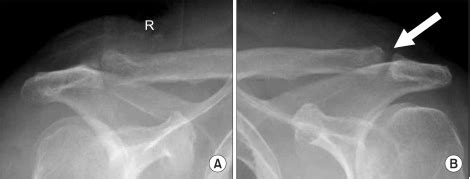 Ac Joint Widening Radiology Acj Lesions Anatomy Vfxc
