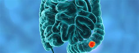 Transanal Endoscopic Microsurgery Tem Conditions And Treatments