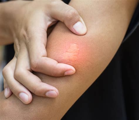 9 Popular Insect Bites And How To Identify Treat And Prevent Them