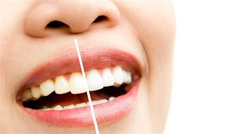 Top White Spot Removal In Chennai Expert Dental Care