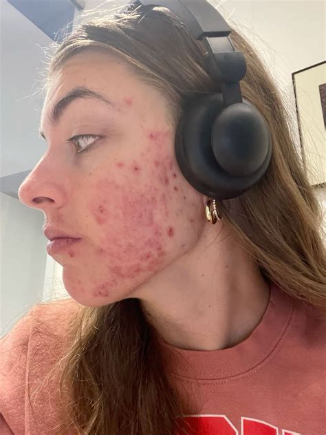 Accutane Month 2 Accutane Acne Skin Acne