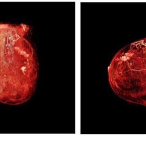 A Frontal View Of 3d Breast Mri B Lateral View Of 3d Breast Mri Download Scientific Diagram
