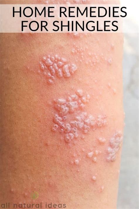What Specialist Treats Shingles Ukzfm