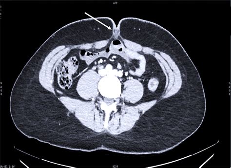 Ct Scan Axial View Showing The Uc As Depicted By The White Arrow Download Scientific Diagram