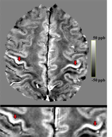 T1 Weighted Image Based Automated Parcellation Of The Primary Motor
