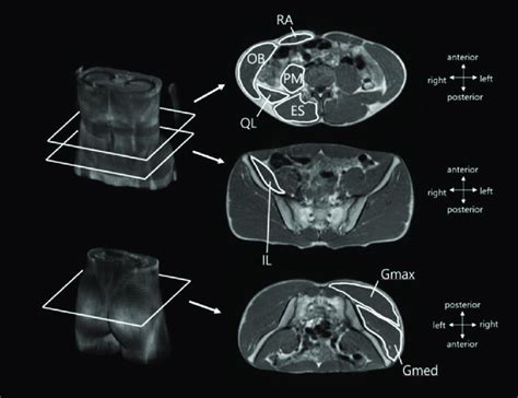 Examples Of Muscle Cross Sectional Areas Csas In Magnetic Resonance Download Scientific