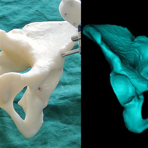 Intelligent Robot Assisted Fracture Reduction System For Pelvic