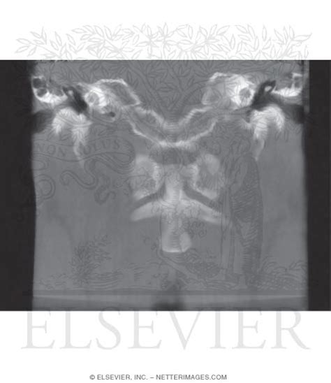 CT Image Coronal View