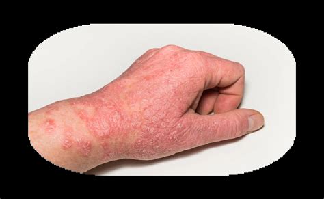 Klinik Spesialis Dermatitis Klinik Pandawa
