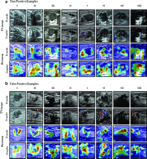 Visualization Of The Attention Heatmaps Of Breast Lesions In The B Mode Download Scientific