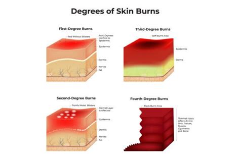Degrees Of Skin Burns Designs Graphics