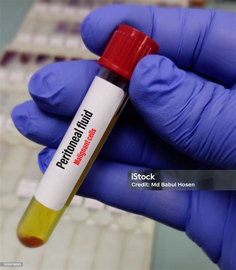 의료 기술자는 악성 세포 검사 자궁 내막염 암종 세포학 종양학을 위해 복막액을 보유하고 있습니다 개념에 대한 스톡 사진 및 기타 이미지 Istock