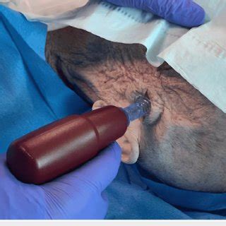 Advance The Intraosseous IO Needle With The Power Driver Until The Download Scientific