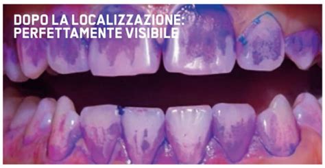 dental hygiene with gbt® protocol the revolution of professional oral hygiene mauro savio