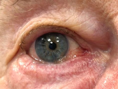 Entropion Surgery Correcting Eyelid Position My Eye Clinic