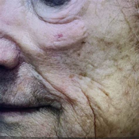 Modified Rhombic Flap Repair Of Melanoma Cheek Melanoma Scan