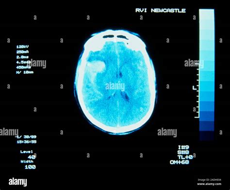 Computed X Ray Tomography Ct Scan Of The Brain Showing A Subarachnoid Haemorrhage The Result
