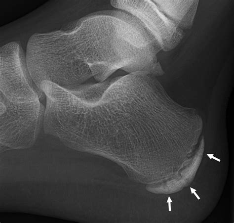 Calcaneal Apophysitis Severs Disease Foot Care Headquarters