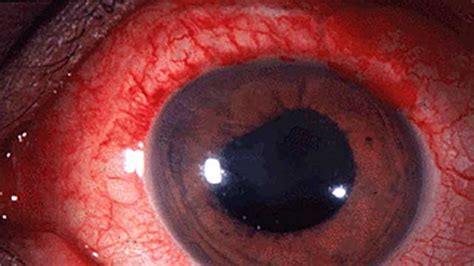 Uveitis Anterior Lesson Identifying Systemic Sources Of Uveitis