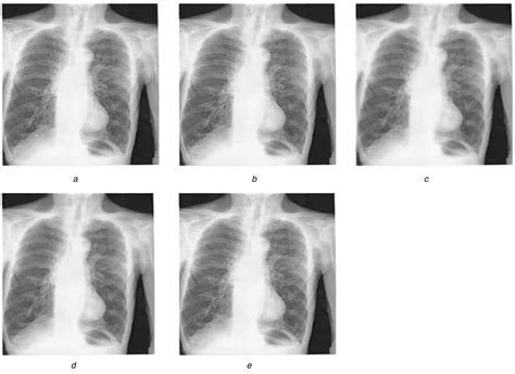 Chest X‐ray Image Denoising Method Based On Deep Convolution Neural Network Jin 2019 Iet
