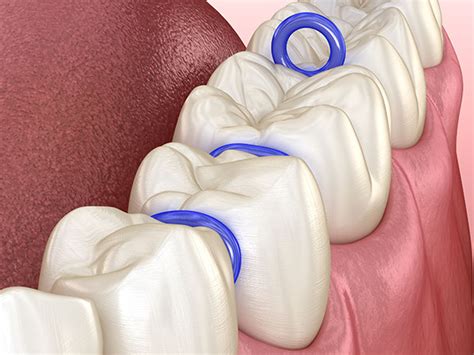 Separators Or Spacers Orthodontist Sunbury Oh