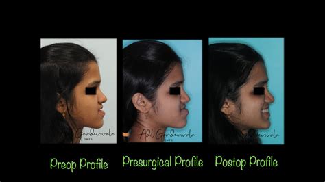 Prognathic Profile At Dominic Chumleigh Blog