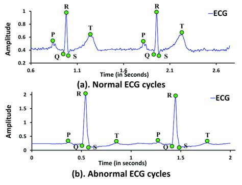 Feature Points Delineation In A Normal Ecg Cycles B Abnormal Ecg