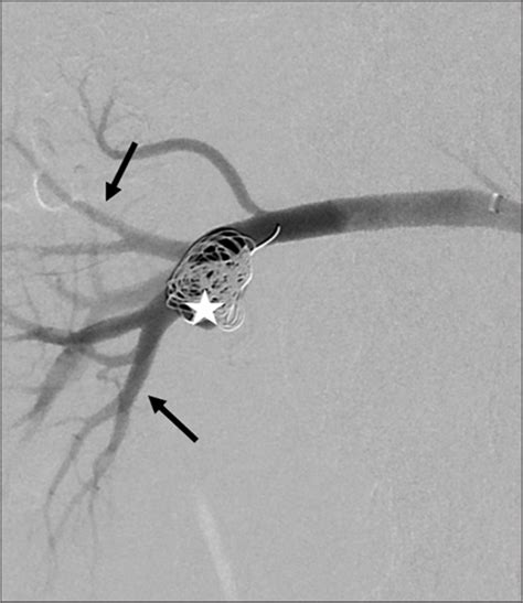 Coil Embolization Of Renal Artery Pseudoaneurysm At Erin Ayers Blog
