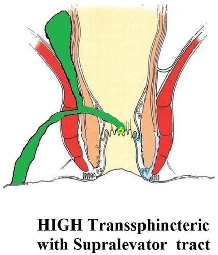 Transsphincteric Fistula Treatment Alhfo