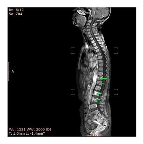 T1 Fat Saturated Post Contrast Mri Image Revealed Multiple Enhanced