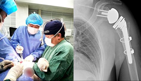 Мөрний үеийг бүтэн солих мэс заслыг Монголд анх удаа эмчилгээнд нэвтрүүллээ Peak News