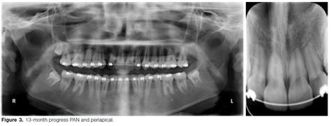 Treatment Of A Severe Class Ii Malocclusion With Pre Existing Root