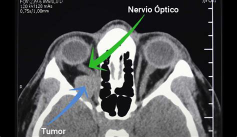 Tumores De La Órbita Somos Mirada