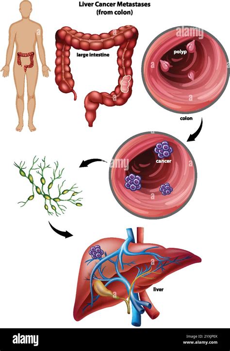 Illustration Of Cancer Spread From Colon To Liver Stock Vector Image