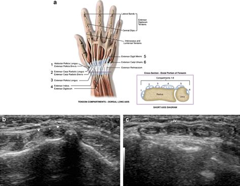 Extensor Compartment Radiology At Phoebe Bateman Blog