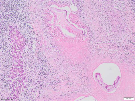 Hepatic Alveolar Echinococcosis Image