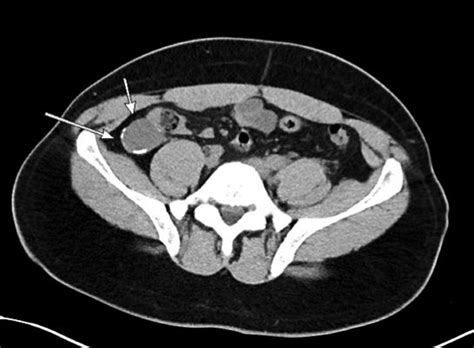 B Coronal Image Of The Same Ct Demonstrating Fluid Filled Appendix