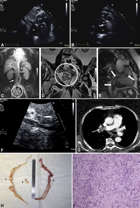 Intracardiac Leiomyomatosis Complicated By Pulmonary Embolism A