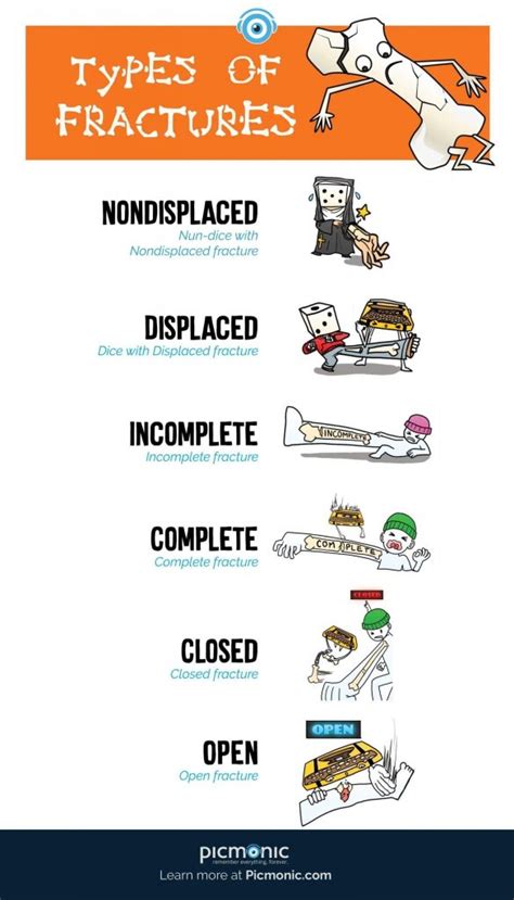 Complicated Fracture Examples