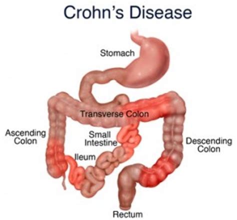 10 Facts About Crohns Disease Fact File