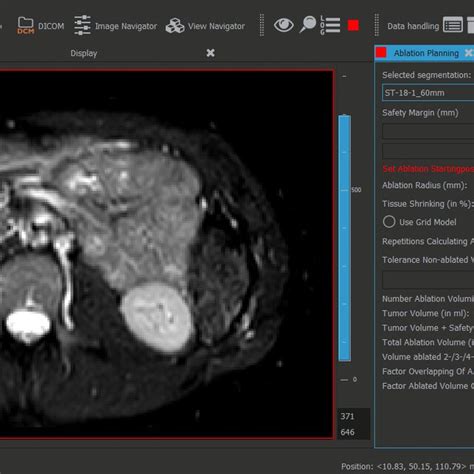 computed planning proposal for a tumour red segmented in a mri image