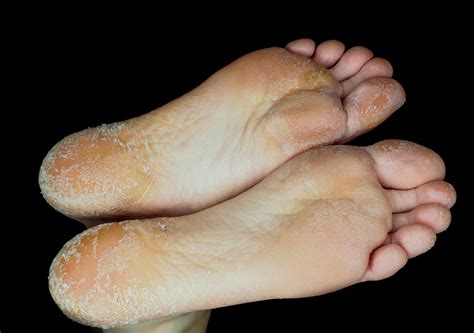 Itchy Bumps On Bottom Of Feet
