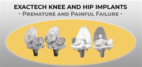 Exactech Knee And Hip Implant Investigation Preuss Foster Law