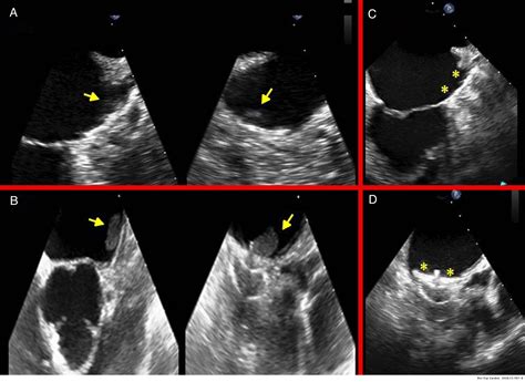 Late Thrombosis Associated With Left Atrial Appendage Closure Devices Is It Rare Or Is It