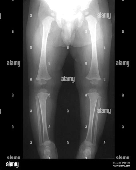 Leg Bones Of 18 Month Old Infant Frontal X Ray This X Ray Shows The