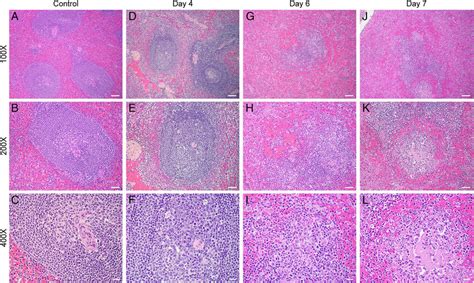 Hande Spleen Mid Disease And Terminal Histopathologic Findings For The