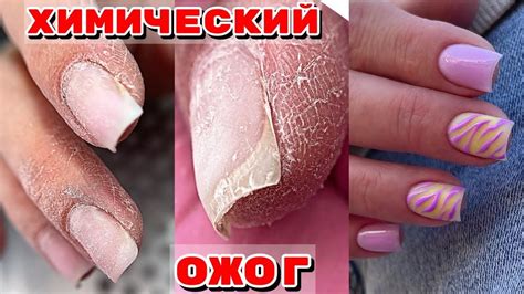 ХИМИЧЕСКИЙ ОЖОГ 😐 Трещины на коже 💅 Сложные руки 💅 Маникюр - YouTube